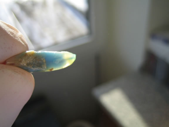 Endodontics – Photolase