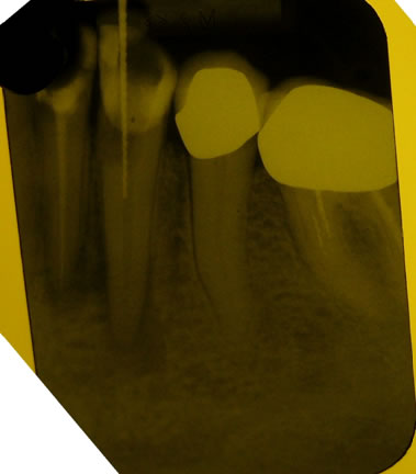 Endodontics – Photolase