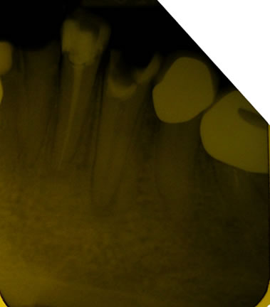 Endodontics – Photolase