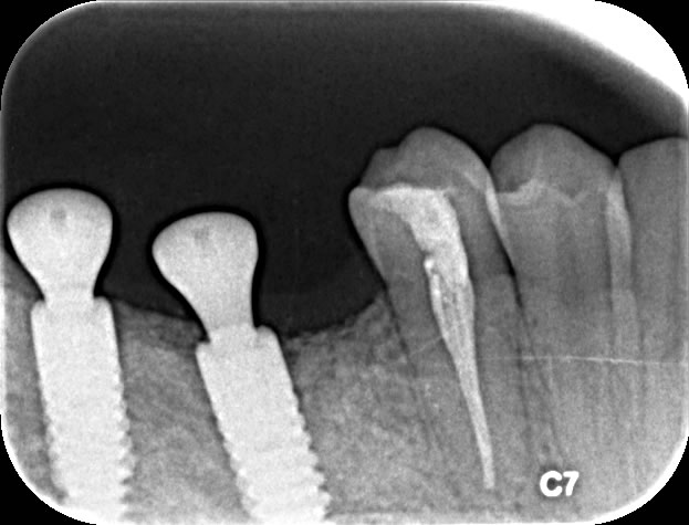 Peri-implantitis – Photolase