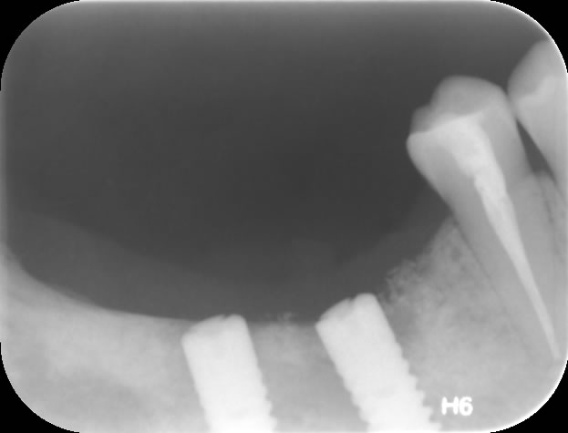 Periimplantitis – Photolase